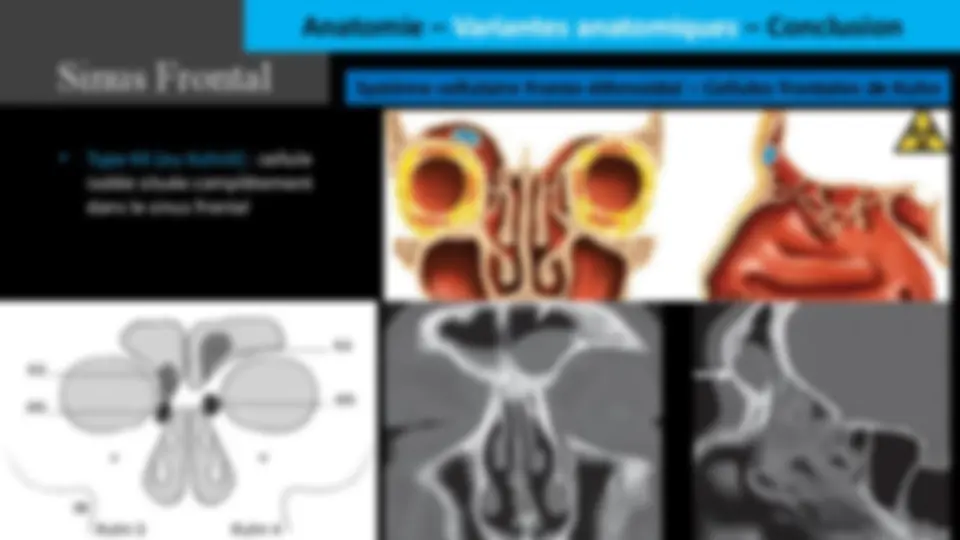 Variantes anatomiques des sinus de la face | Schémas Anatomie | Docsity