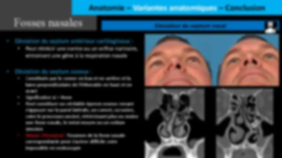 Variantes anatomiques des sinus de la face | Schémas Anatomie | Docsity