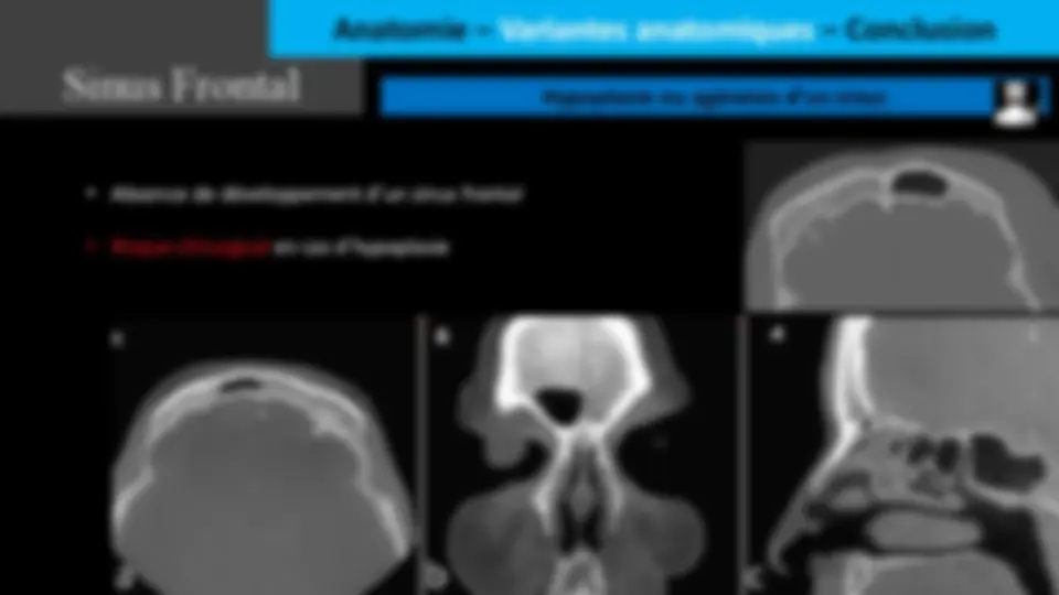 Variantes anatomiques des sinus de la face | Schémas Anatomie | Docsity