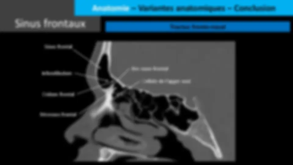 Variantes anatomiques des sinus de la face | Schémas Anatomie | Docsity