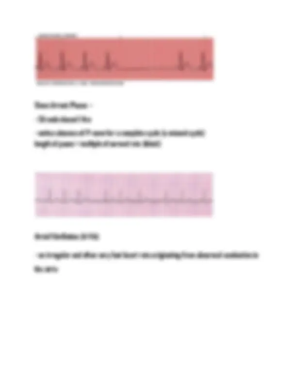 Dysrhythmia Basics: Understanding Common Heart Rhythms and Their ...
