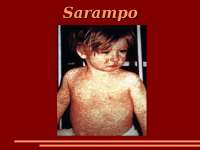 Sarampo- apresentação power point - Contem descrição, sintomas ...