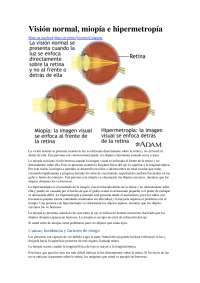 Visión normal, miopía e hipermetropía - Apuntes de Enfermería - Docsity