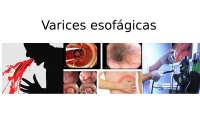 Varices esofágicas en el adulto - Docsity