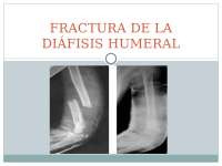 Fracturas de diafisis humeral - Docsity