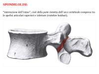 Anatomia spondilolisi spondilolistesi - Docsity