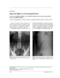 Signo neumoperitoneo - Docsity