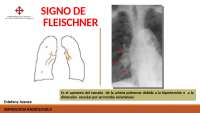Signo de Fleischner Signo de Fleischner Signo de Fleischner Signo de ...