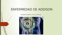ENFERMEDAD DE ADDISON | Diapositivas de Endocrinología - Docsity