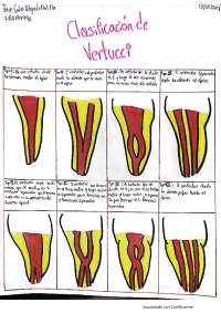 Clasificación de Vertucci | Transcripciones de Endodoncia | Docsity