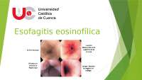 Esofagitis eosinofila - Docsity