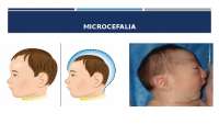 MICROCEFALIA EN PEDIATRIA - Docsity