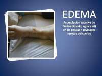 Clasisficacion de edemas | Diapositivas de Enfermería Clínica - Docsity