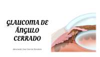 Glaucoma ángulo cerrado | Diapositivas de Oftalmología | Docsity