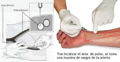 ¿Qué debo saber sobre la gasometría arterial? - Docsity